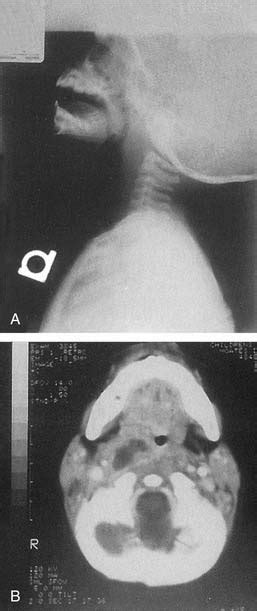 Pharyngitis And Adenotonsillar Disease Ento Key