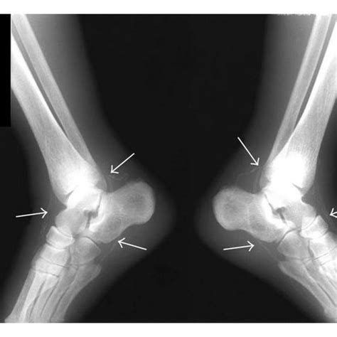 PDF Vascular Calcification In An Adolescent Treated With Long Term Peritoneal Dialysis