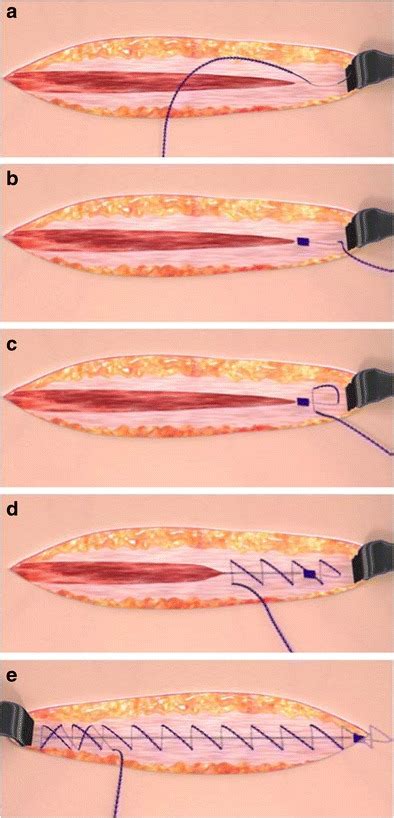 A High Strength Absorbable Antibacterial Knotless Tissue Control
