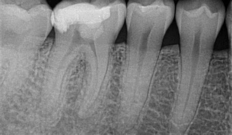 The Evidence Base For Pulpotomy In Irreversible Pulpitis The Harley Street Academy Of Advanced