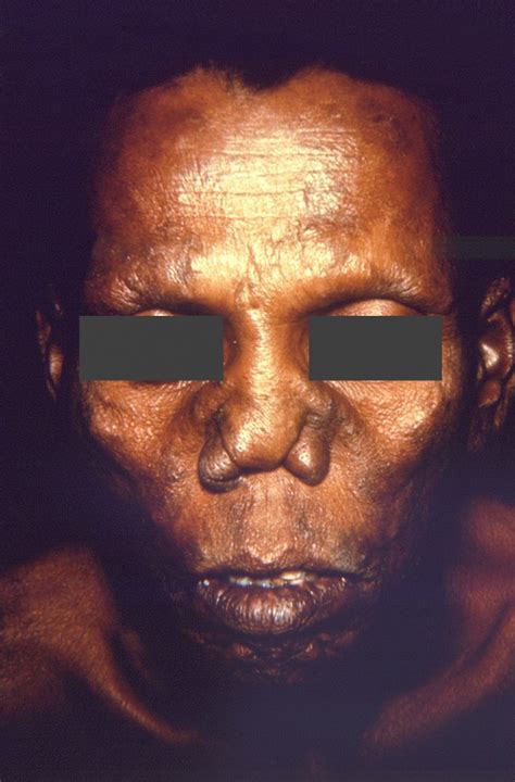 Leprosy Infectious Disease Merck Manual Professional Edition