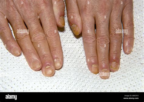 Fungal Infection Hands Ears