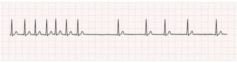 Atrial Fibrillation Rvr Ecg Atrial Fibrillation By Ioannis