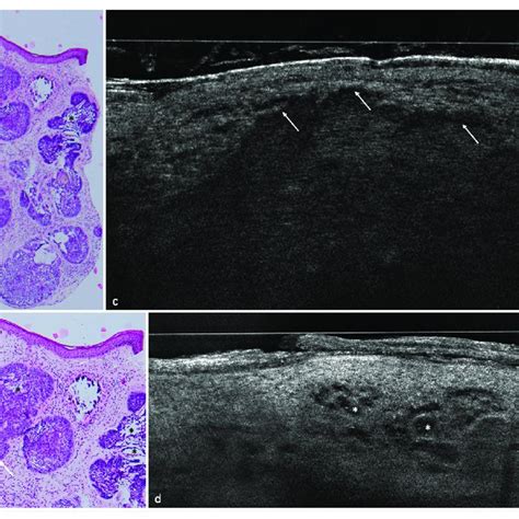 Nodular Bcc With Cystic Parts In The Nasolabial Fold Of A 76 Year Old