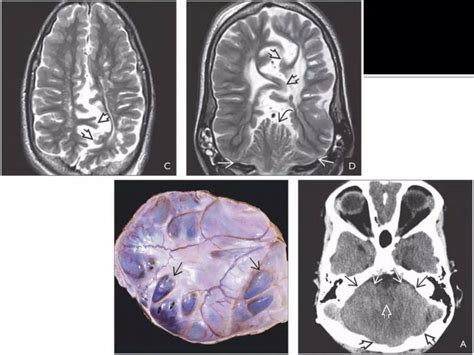 Congenital Brain Anomalies Pdf