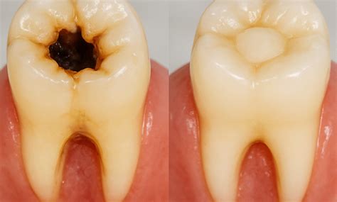 Before And After Root Canal Treatment Results • Docintur