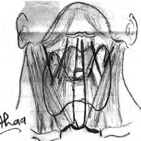 Topographic Anatomy Of The Superior Thyroid Pole Fig 2 Exposure Of