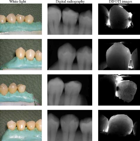 Figure 5 From Observer Reliability In Approximal Caries Detection Using Digital Radiographs And