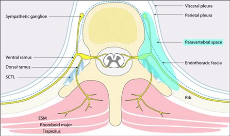 Paravertebral Block Flashcards Quizlet