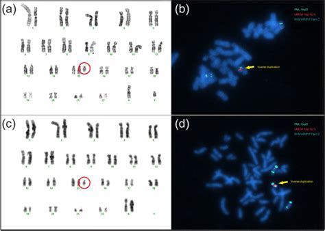 Karyotype And Fish Analysis A Karyotype Of Patient 1 Illustrates