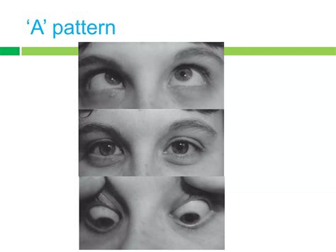 A V Pattern Strabismus Pptx