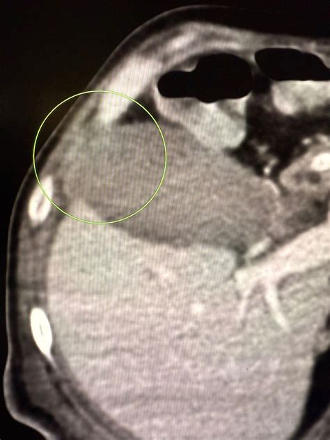 The Tensile Gallbladder Fundus Sign Is A Ct Finding That Suggests
