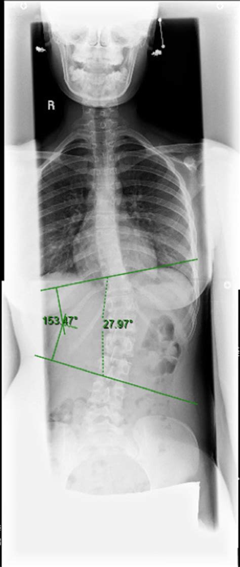 Full Length Spine—clinical Correlations With Specific Phenotypes And