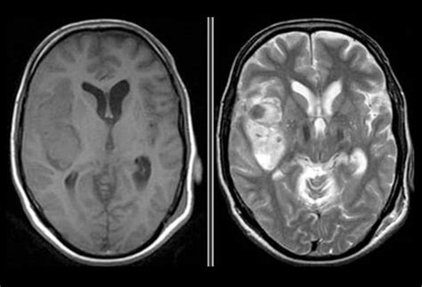 Brain Bleed Brain Bleed On Mri
