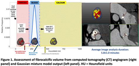 Quantitative Computed Tomography Angiography For The Evaluation Of Valvular Fibrocalcific Volume