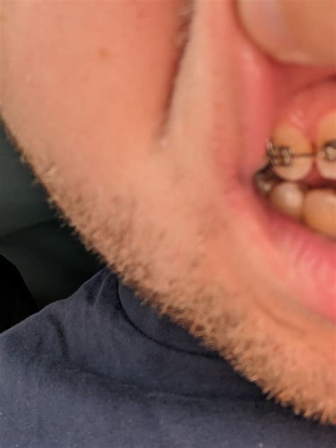 Gap Between Teeth R Braces