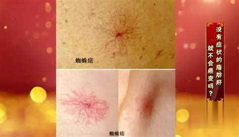 肝脏好不好，看手就知道！找准养肝穴，睡前贴一贴，肝好人不老~ 知乎
