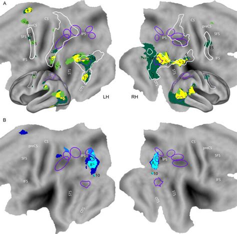 Statistical Parametric Maps Spms Showing Activated Voxels Threshold