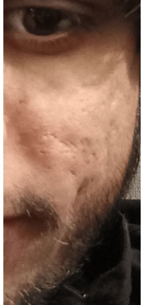 Acne Scarss Please Helppp R30plusskincare