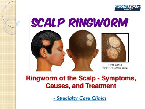 Ppt Ringworm Of The Scalp Symptoms Causes And Treatment