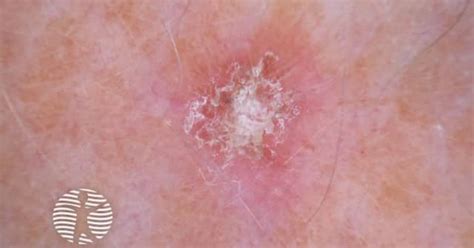 Actinic Keratoses Affecting The Face Image