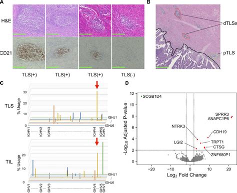 Artificial Intelligence Based Spatial Analysis Of Tertiary Lymphoid Structures And Clinical