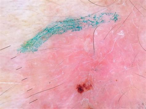 Dermoscopy Bcc M Bosseila 2018 Ppt