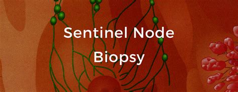 Sentinel Node Biopsy The Breast Cancer School For Patients