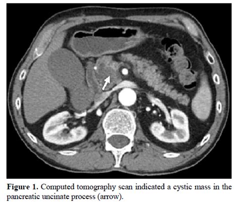 Pancreatic Carcinosarcoma Case Report Of A Rare Type Of Pancreat
