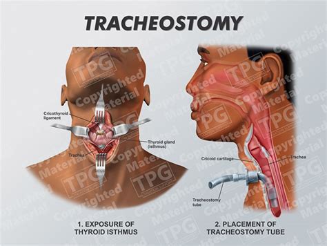 How To Perform A Tracheostomy Tracheostomy What It Is Procedure
