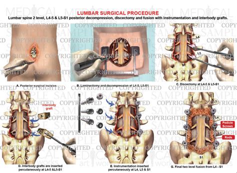 2 Level L4 L5 S1 Posterior Lumbar Interbody Fusion Decompression And Discectomy — Medical