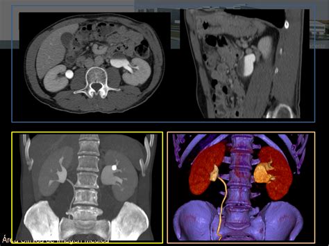 Extrarenal Pelvis