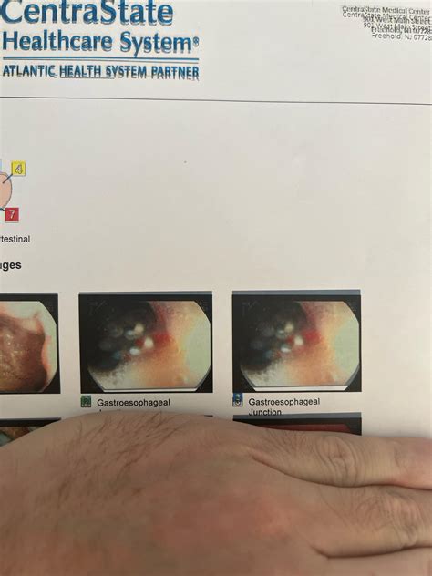 Endoscopy Results Rsurgicalendoscopy