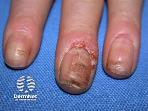 Hand Dermatitis Images