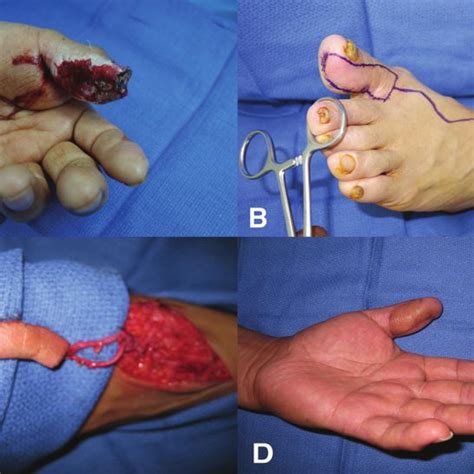 A Left Thumb Distal Tip Avulsion Amputation With An Extended