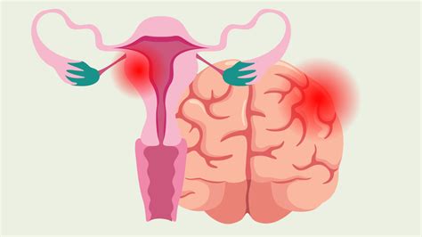 Migräne Und Endometriose