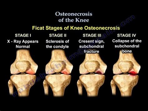 Osteonecrosis Of The Knee Everything You Need To Know Dr Nabil