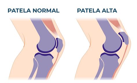 Luxação Da Patela Dr Guilherme Losso