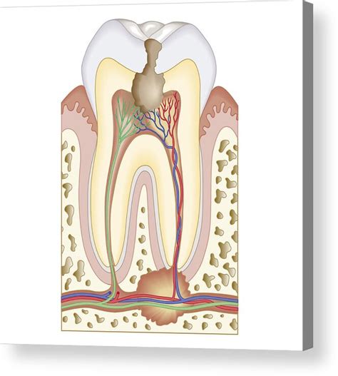 Cross Section Biomedical Illustration Of Pulp And Root Abscess In Molar