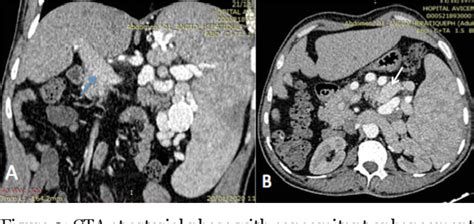 Figure 1 From Upper Gastrointestinal Bleeding Revealing A Gastric