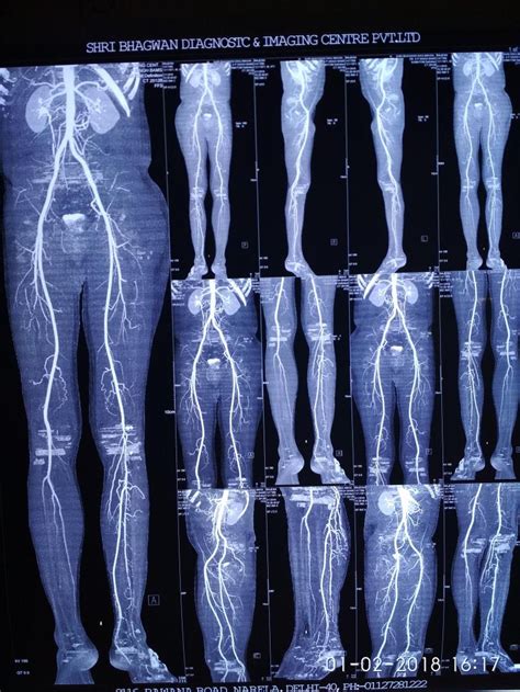 Vaseem Ahamad On Linkedin Peripheral Angio