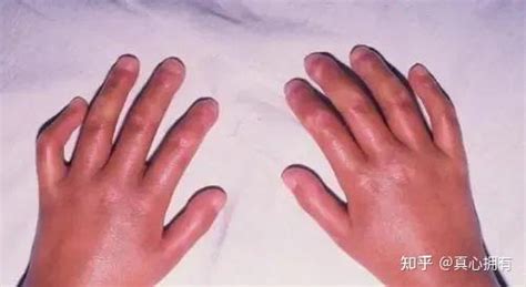 几招教你分辨硬皮病！ 知乎