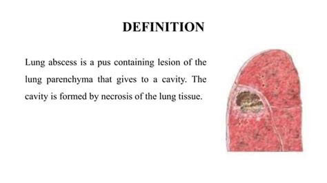 Lung Abscess 102210 Pptx