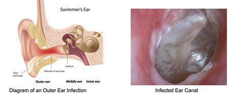 Ear Infection Discharge