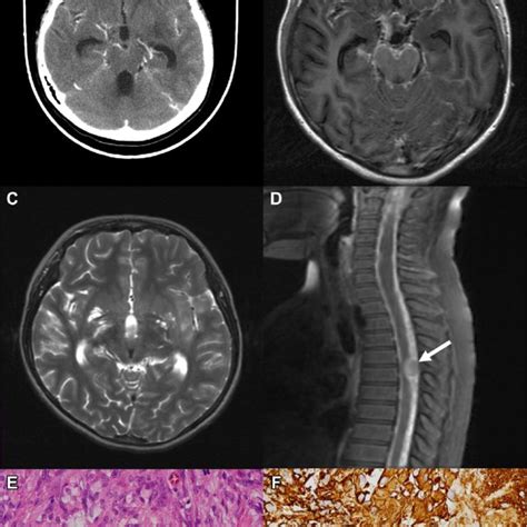 Case 1 A Head Computed Tomography Ct Revealed Hyperdensity In The Download Scientific