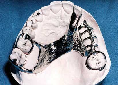 Alternative Esthetic Clasp For Removable Partial Dentures On Maxillary