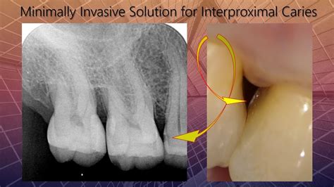 Minimally Invasive Solution For Interproximal Caries Youtube