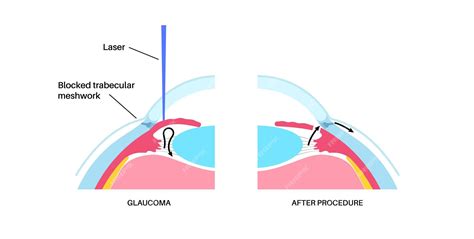 Premium Vector Iridectomy Medical Poster