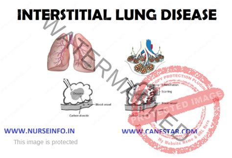 INTERSTITIAL LUNG DISEASE Nurse Info