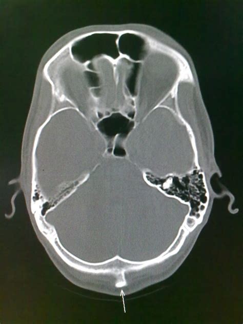 Occipital Protuberance